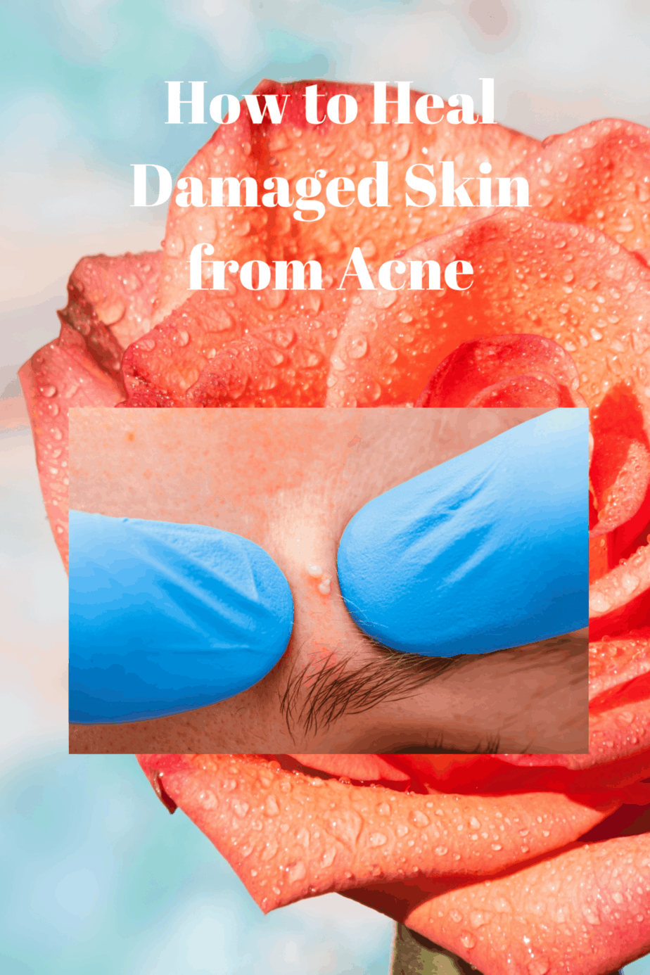 How to Heal Damaged Skin from Acne - Fast Life Tips